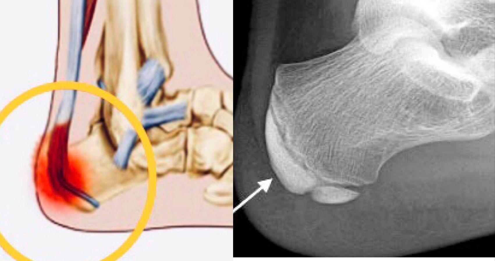 跟骨炎宣布：將於骨骼成型後停止發作 | am730